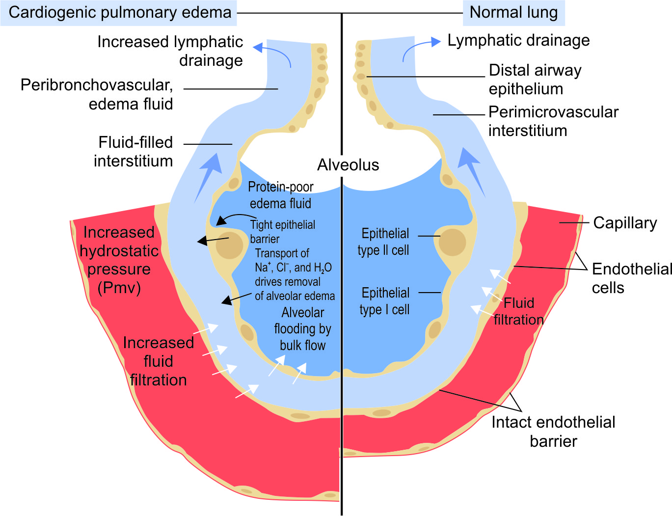 From Heart Failure Pulmonary Edema